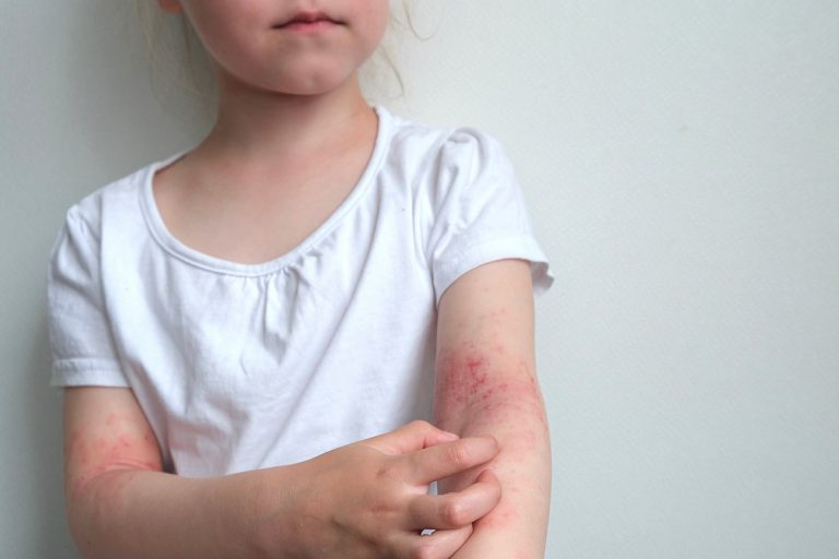 How Do I Know If My Child Has Eczema - Loudoun Pediatric Associates